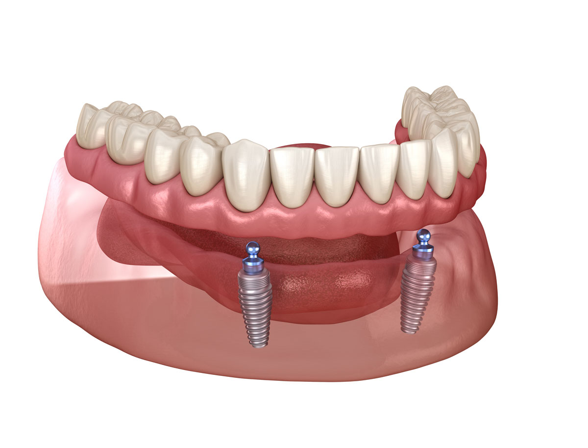 Prothese / Teilprothese – Zaghian Dentalpraxis Frankfurt | Praxis für ...
